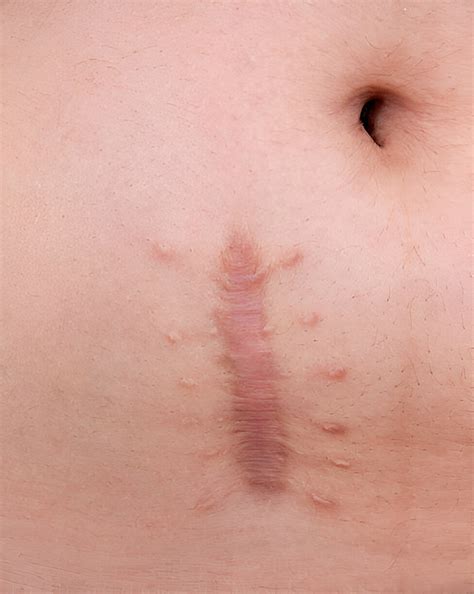 Mengenal Penyakit Keloid Gejala Penyebab Dan Cara Mengobatinya