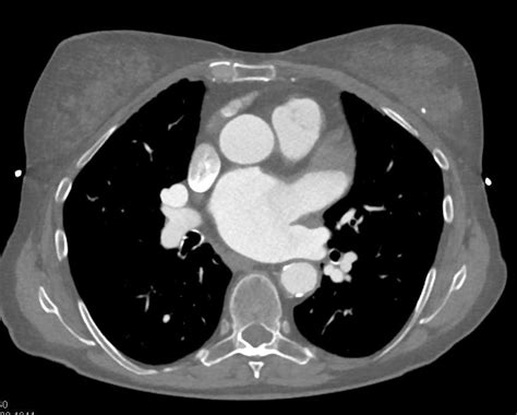 Pseudothrombus In Left Atrial Appendage Cardiac Radiology Case