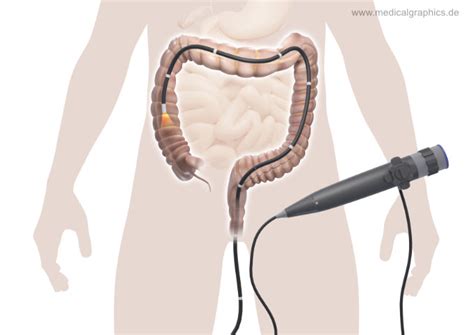 Colonoscopy Silhouette Human Medicalgraphics