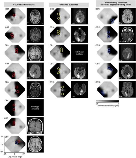 Stroke Visual Field