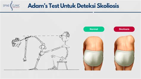 Kenali Adams Forward Bend Test Metode Deteksi Skoliosis Paling Mudah