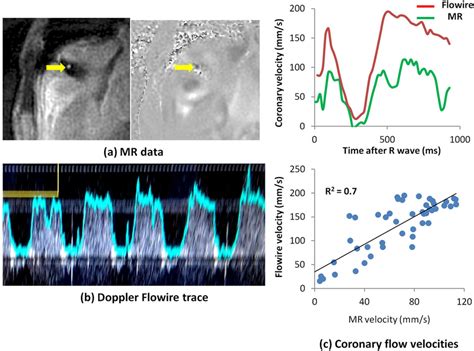 Example Early Diastolic Rca Arrow Magnitude Image And Velocity Map