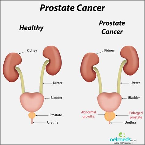 Prostate Causes Symptoms Treatment And Prevention Of Prostate Diseases Healthy Food Near Me
