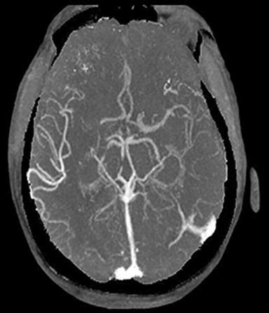 Innovations In CT Imaging Of Acute Stroke Adding Value Reducing Dose Improving Consistency