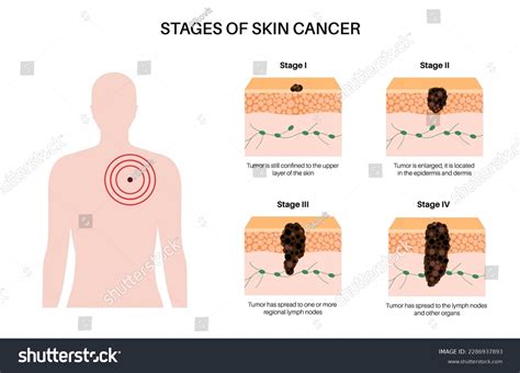 Melanoma Skin Cancer Stages