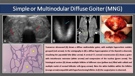 Multinodular Goiter