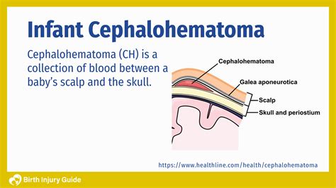 Vacuum Delivery Cephalohematoma At Jenny Abate Blog
