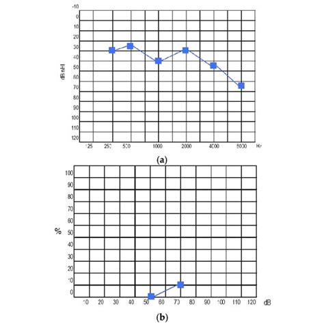 Pure Tone Audiometry A And Speech Audiometry B At Last Visit With