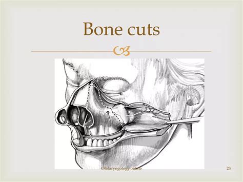 Maxillectomy A Review Pptx