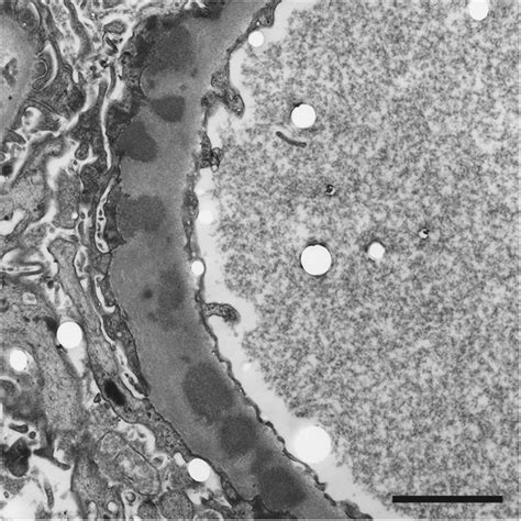 Electron Microscopy Electron Dense Deposits Were Observed Within Download Scientific Diagram