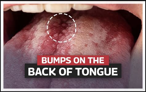Red Bump With Depressed Center At Christine Mayer Blog