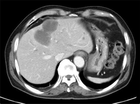 Hepatic Pleomorphic Leiomyosarcoma After Surgery For Gastric Gastrointestinal Stromal Tumor A