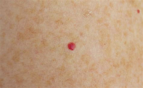 Cherry Angioma Flat Any Natural Treatments For Cherry Angioma Removal