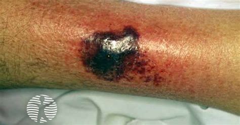Pyoderma Gangrenosum Image