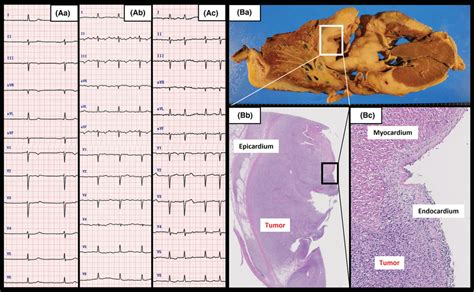 Aa Ectopic Atrial Rhythm Ab Atrial Tachycardia With 31 Download Scientific Diagram