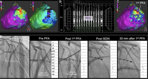Pulsed Field Epicardial Ablation For Vt Storm A Case Report Of Bail Out Therapy Masaaki
