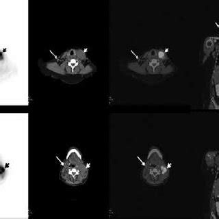 B Axial PET CT PET CT Fusion And Coronal PET CT Fusion Images Download Scientific Diagram