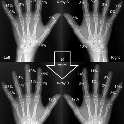 The Prevalence Of Radiographic Oa Corresponding To Kl Grade 2 Or