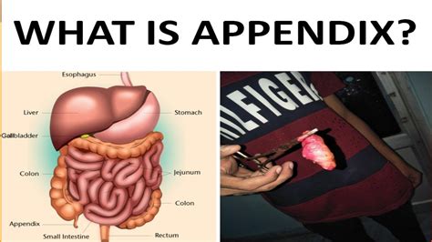 Appendix Location