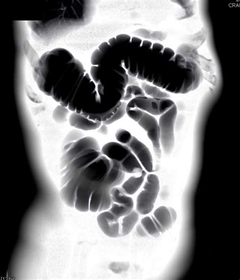 Polyp In Tortuous Descending Colon Which Is On A Stalk Colon