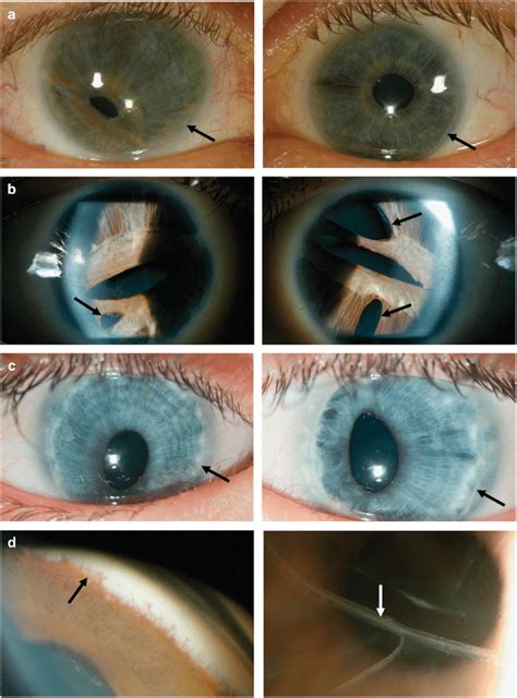Clinical Photographs Of Individuals With Ocular Features Of