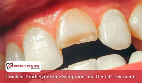 Cracked Tooth Syndrome Symptoms And Dental Treatments