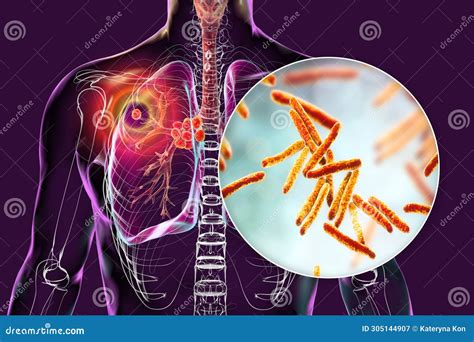 Primary Lung Tuberculosis 3d Illustration 305144907