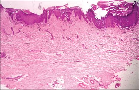 Unilateral Striate Punctate Keratoderma An Extremely Rare Presentation