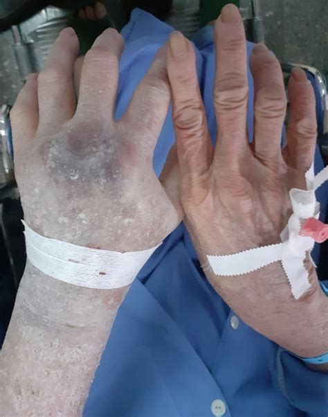 Iv Complications Extravasation