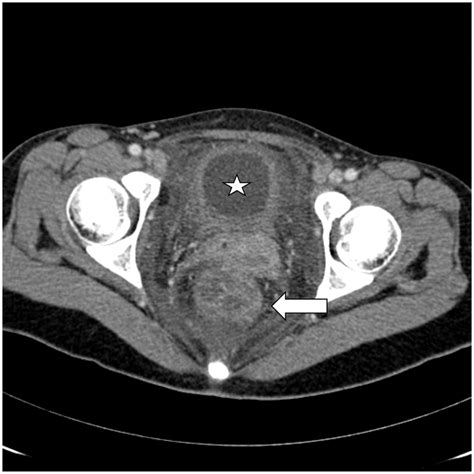Ct Scan Of The Pelvis Showing A Thick Walled Urinary Bladder White