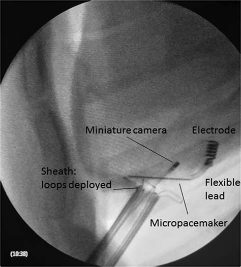 Minimally Invasive Implantation Of A Micropacemaker Into The