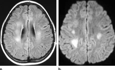 Methotrexate Induced Neurotoxic Effects In A 12 Year Old Girl With