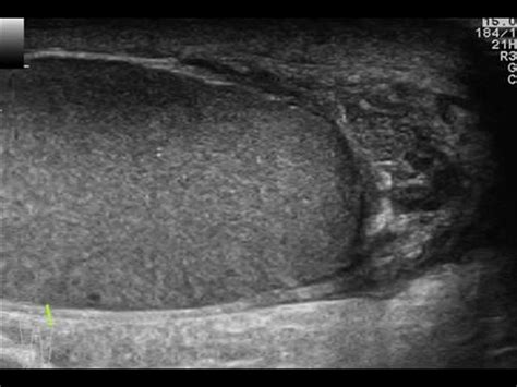 Urinary Tract And Male Reproductive System 23 Scrotum Case 236