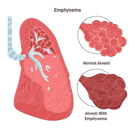 Premium Vector Emphysema Chronic Obstructive Pulmonary Disease Caused