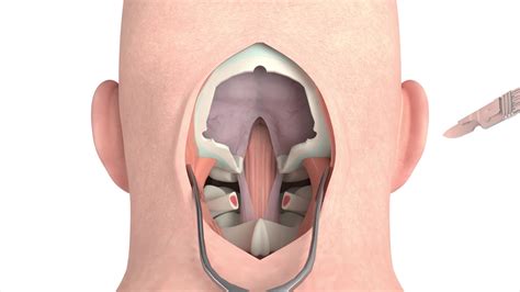 Craniectomy Brain Surgery 3d Animation