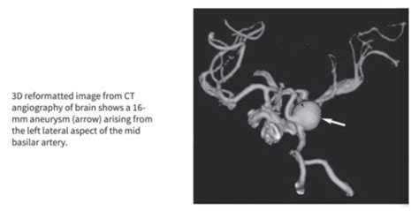 CT Scan Flashcards Quizlet