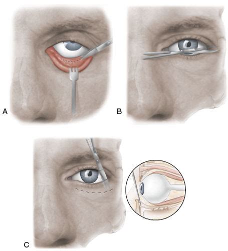 Surgicalcore Table Figure