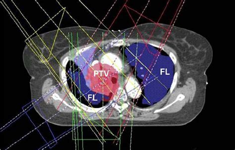 Beam Orientation Of 3 Dcrt A And Imrt B Plan Of The Same Patient