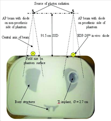 Single Ap Beam Setups In The Phantom Slice For 6 Mv And 10 Mv Photon
