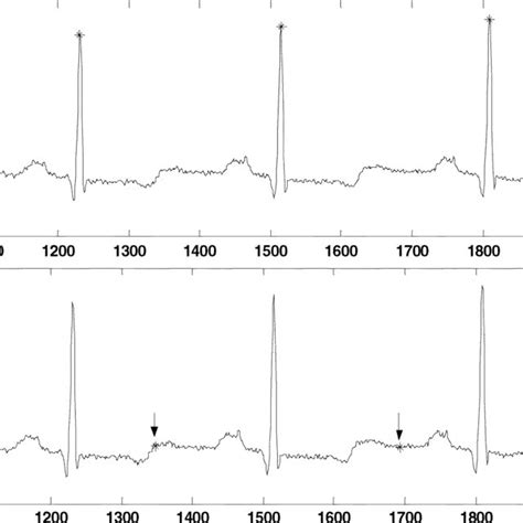segmented ecg signal download scientific diagram