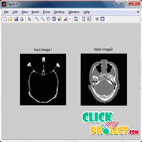 Multimodal Sensor Medical Image Fusion Based On Type 2 Fuzzy Logic In