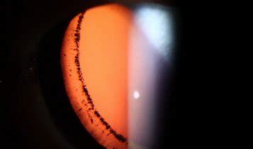 Lines In Ophthalmology Eye Health Nepal