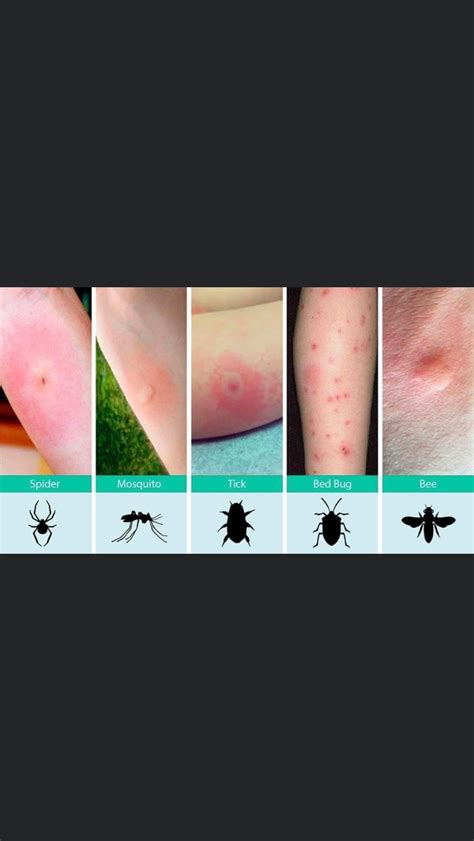 These Detailed Pictures Show The Exact Tick Bite Symptoms To Look Out