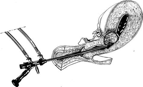 Complications Of Myomectomy Obgyn Key