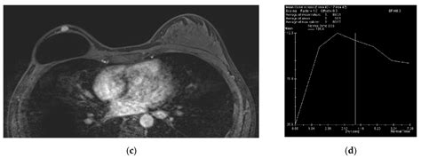 The Usefulness Of Magnetic Resonance Imaging Mri For The Detection Of
