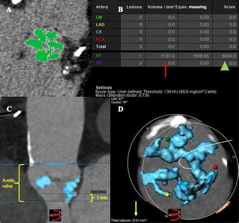 Aortic Valve Calcification Volume And Prognosis In Patients Undergoing