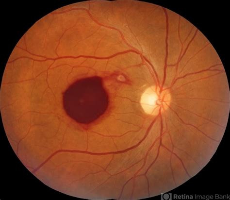 Ruptured Retinal Macroaneurysm Retina Image Bank