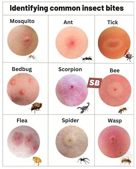 Giada De Laurentiis 🍗🍾 Insect Bites Vary In Appearance Facebook
