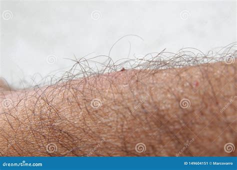Tick Bite On Human Arm Stock Image Image Of Babesiosis 149604151