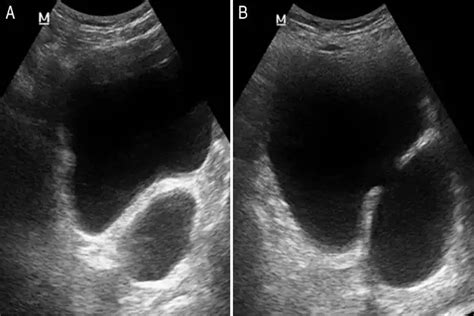 Hipertrofia Prostática Ultrasonografía Médica